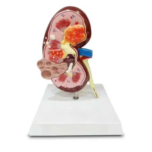 Kidney Cyst Model Delux – MeddeyGo.com